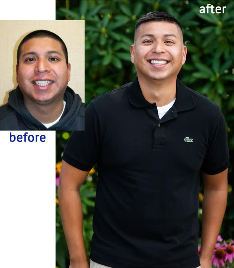 Before and After Brayces Orthodontics
