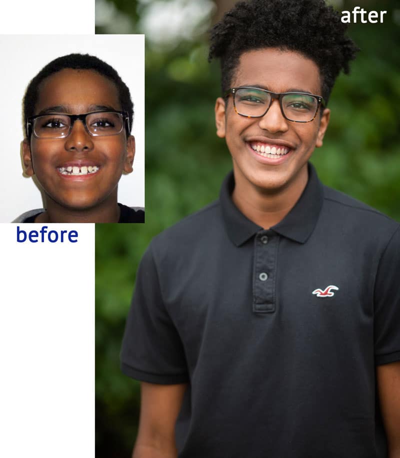 Before and After Brayces Orthodontics