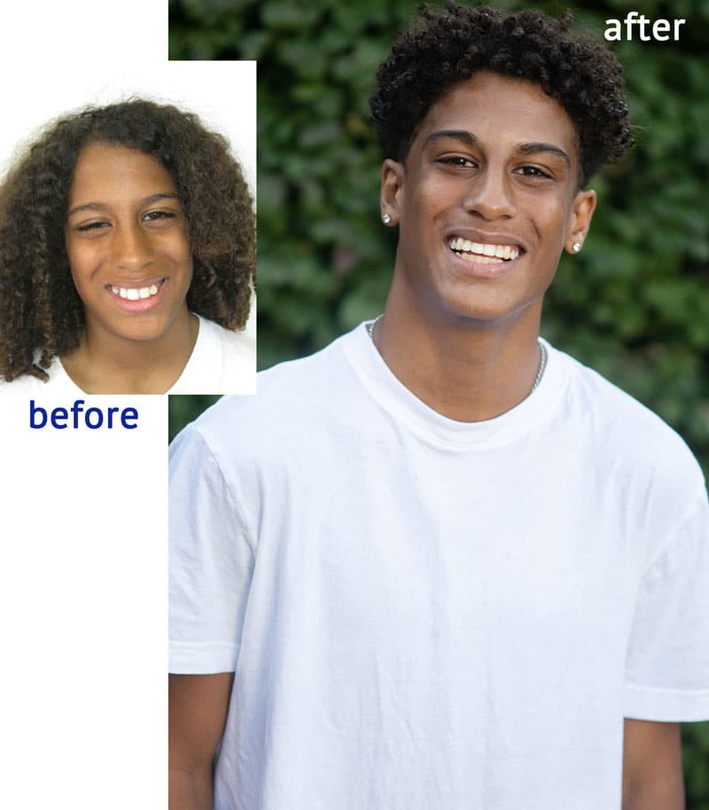 Before and After Brayces Orthodontics