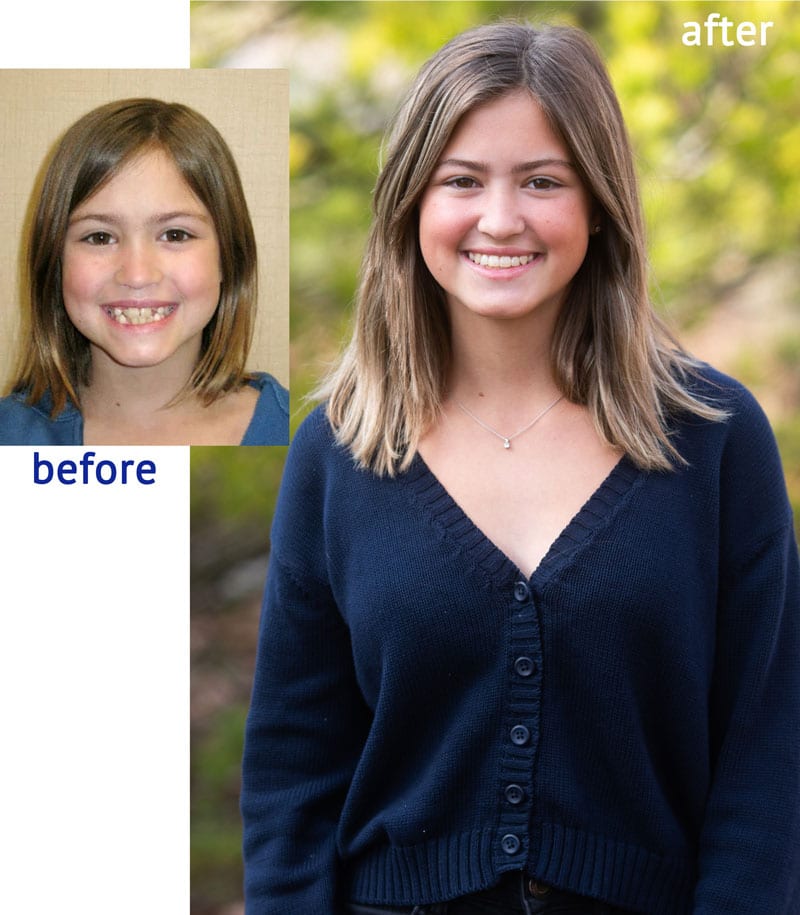 Before and After Brayces Orthodontics