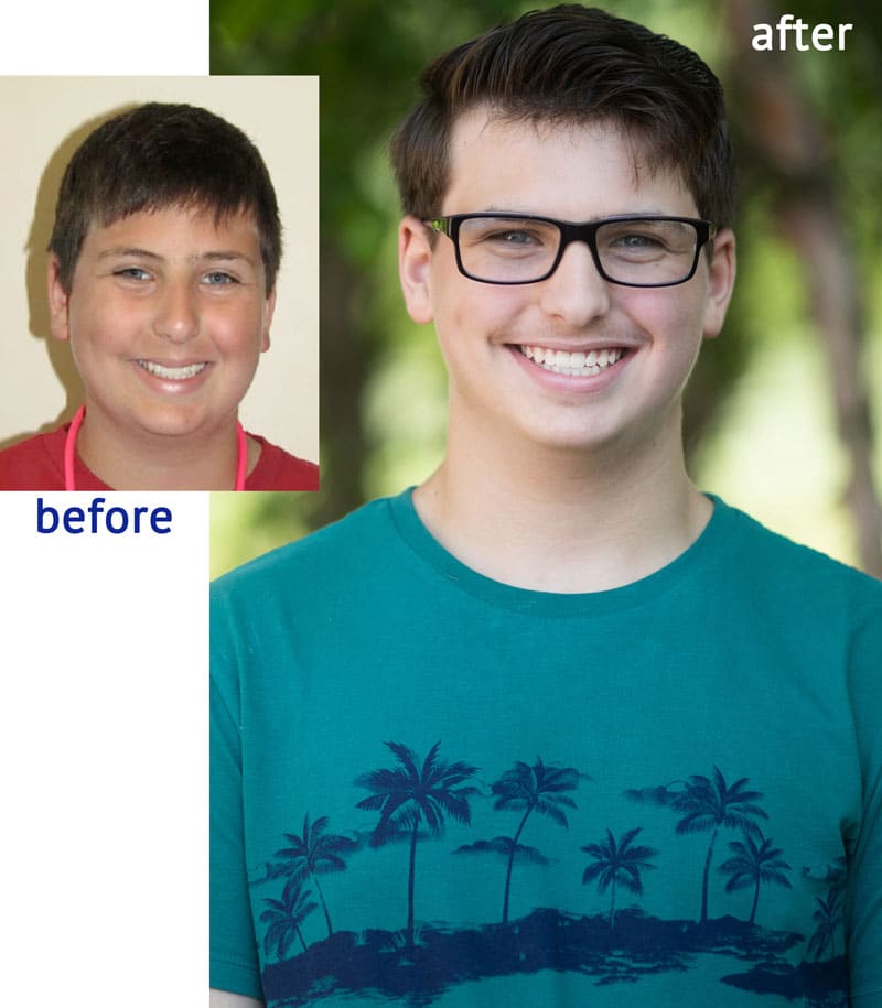 Before and After Brayces Orthodontics