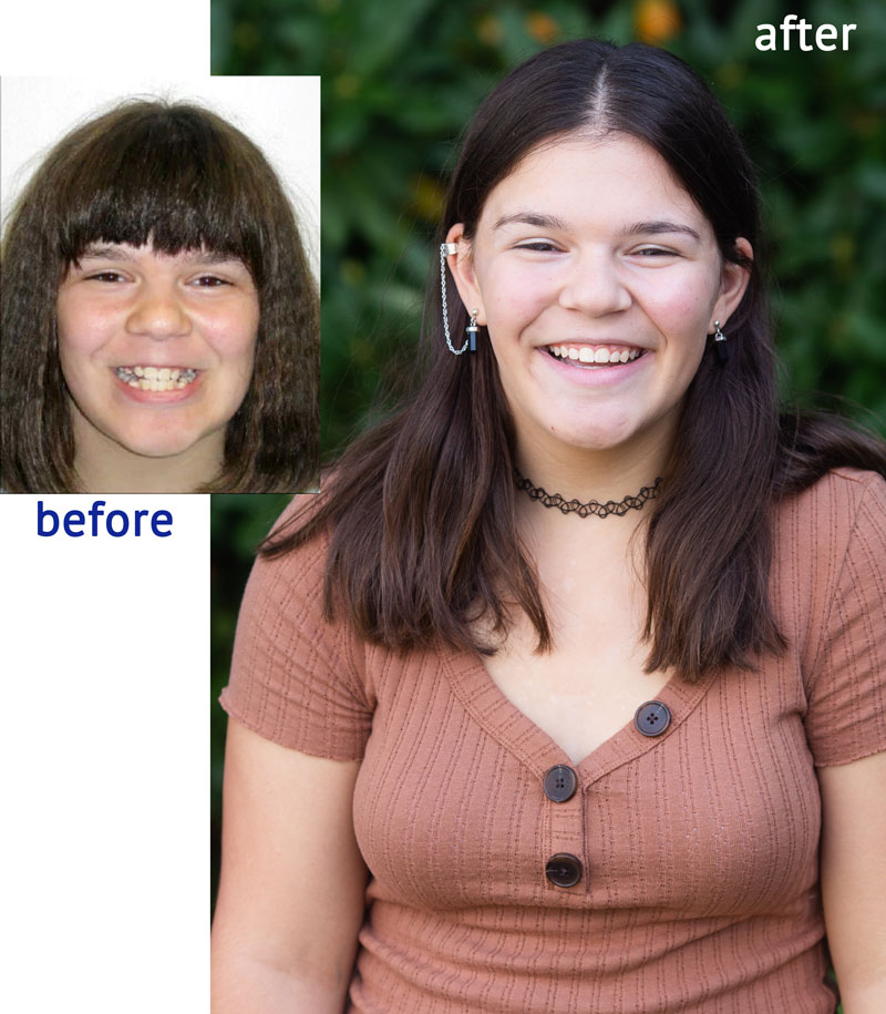 Before and After Brayces Orthodontics